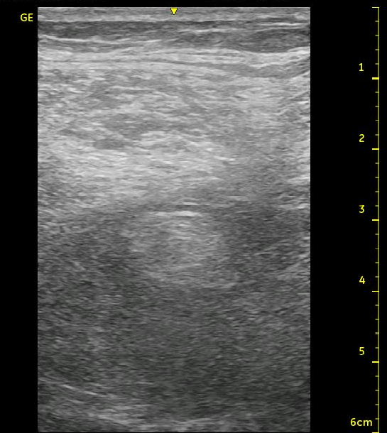 POPLITEAL SCIATIC