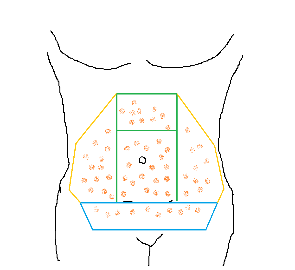 TAP Block Pain Evaluation